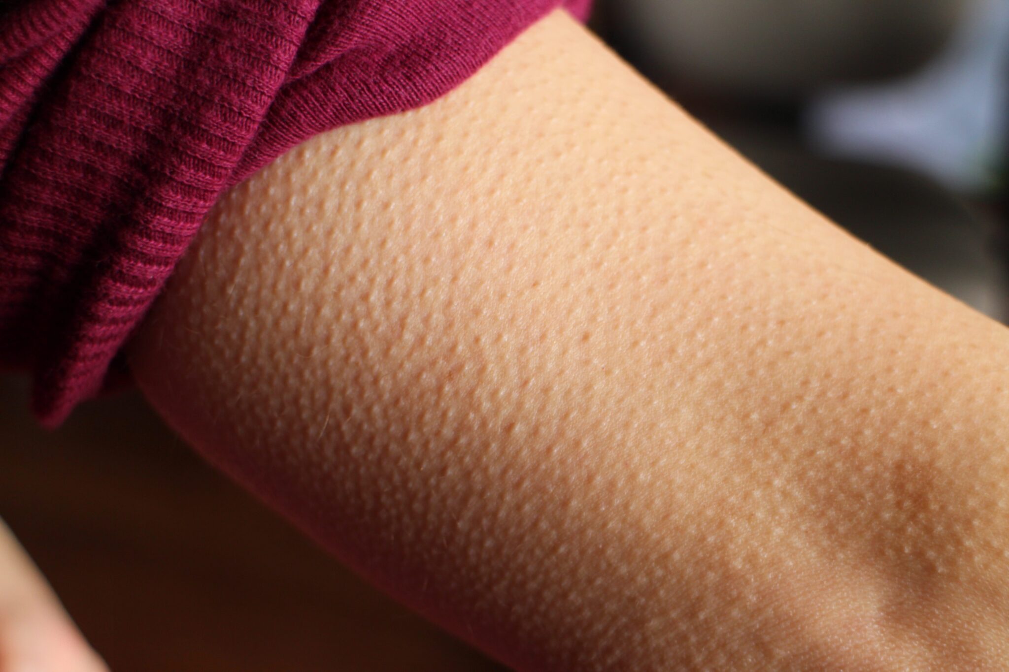 What are goosebumps and why do we get them? The evolutionary ...